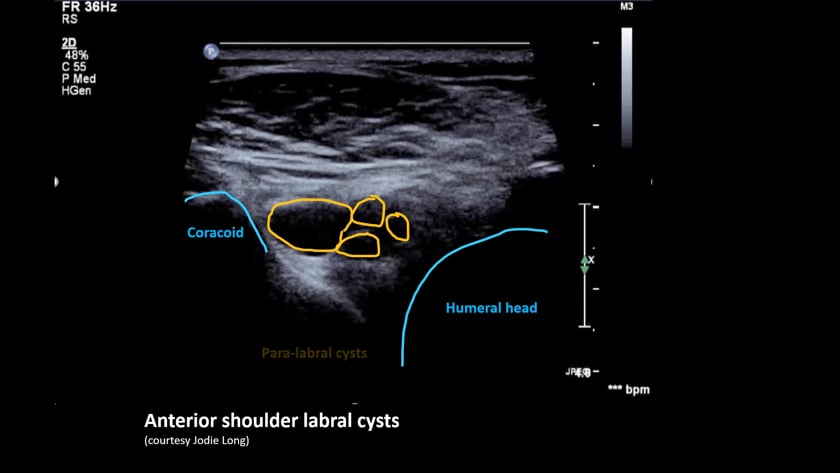 Shoulder pathology – ULTRASOUNDPAEDIA