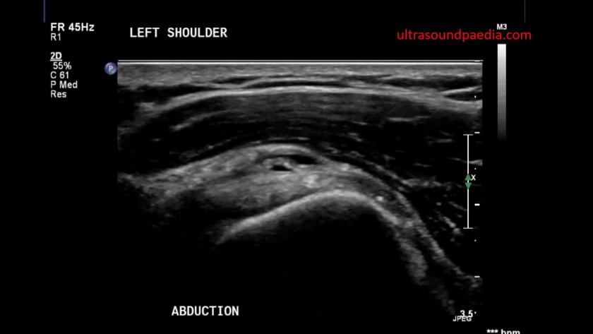 Shoulder pathology – ULTRASOUNDPAEDIA
