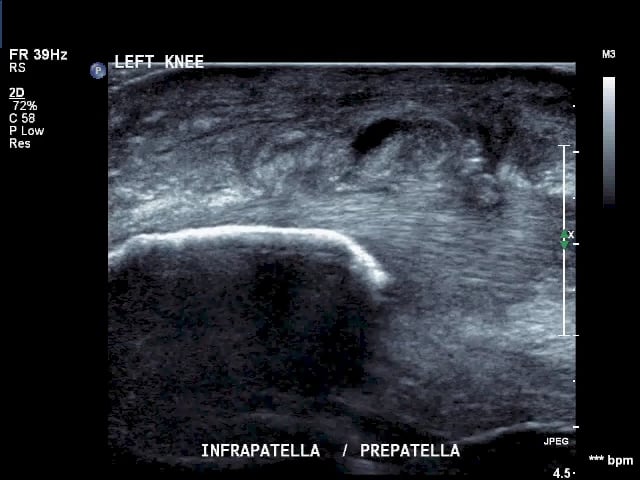 knee pathology – ULTRASOUNDPAEDIA