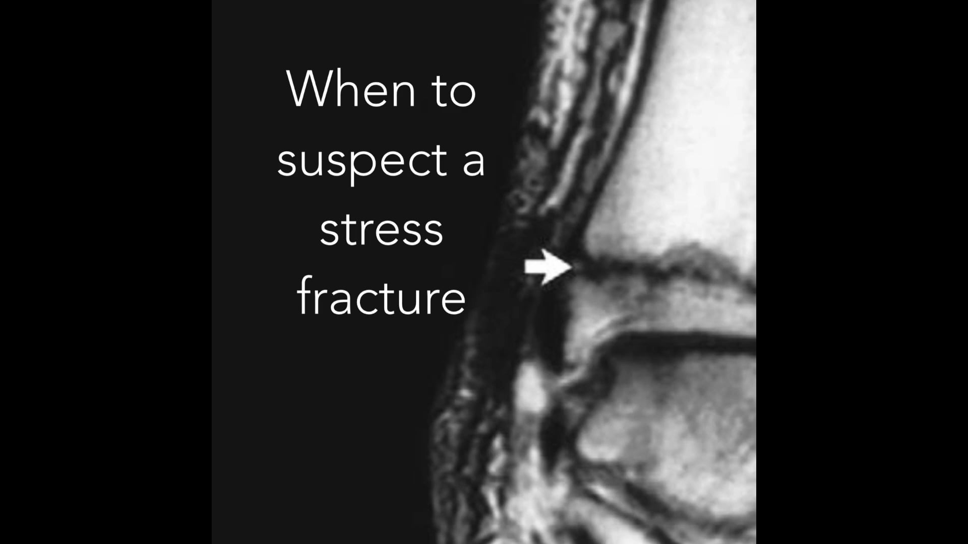 Suspect a stress fracture? with Tom Goom on Vimeo