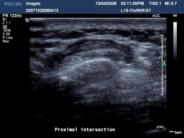 Wrist pathology – ULTRASOUNDPAEDIA