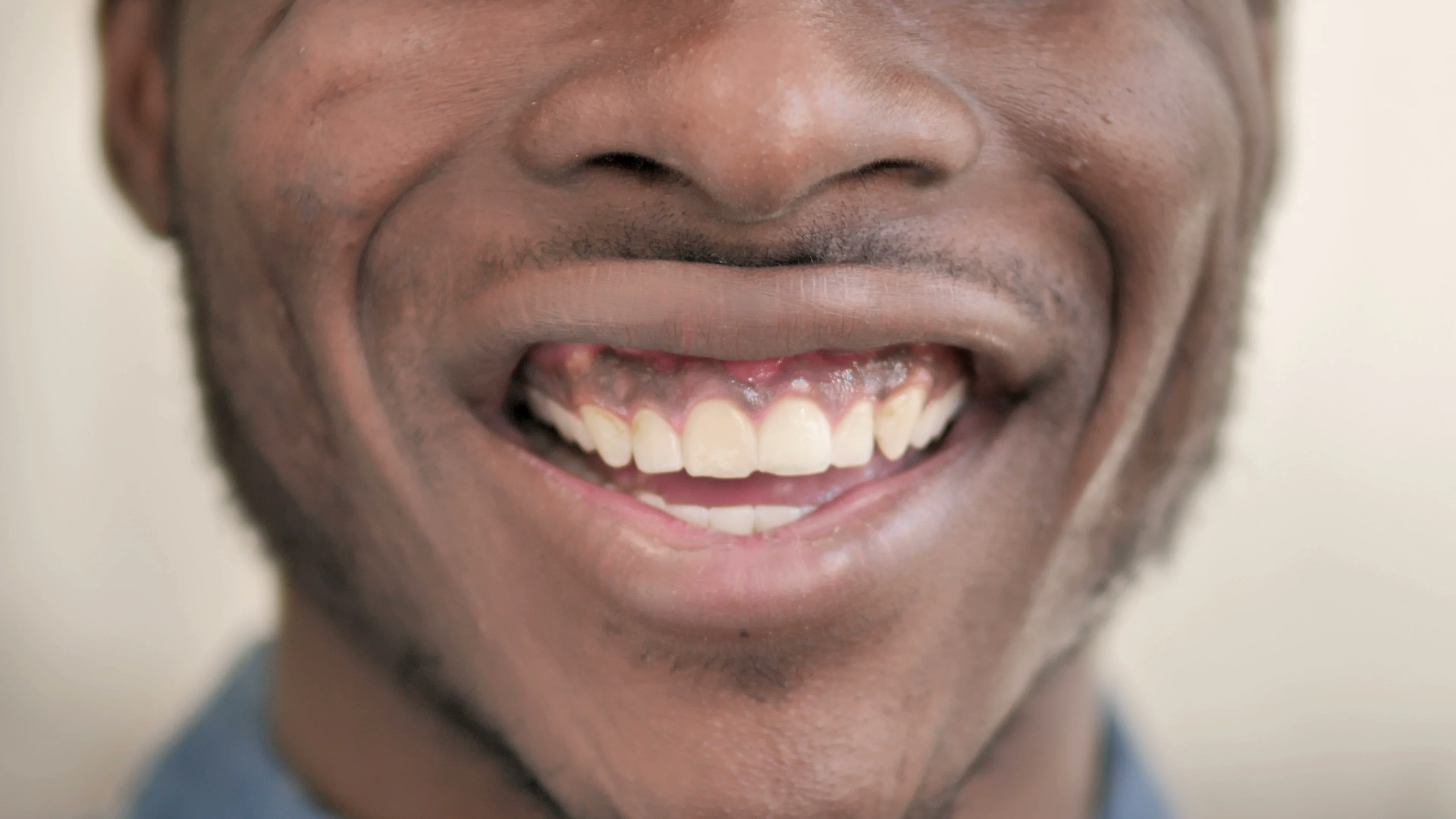 Gummy Smile on Vimeo