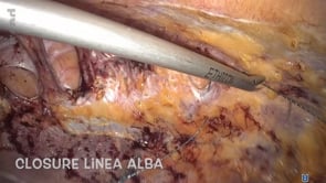 Intraperitoneal onlay mesh (IPOM) technique for intraperitoneal ventral ...