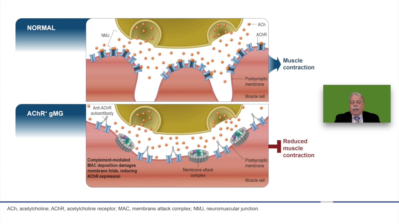 Video Abstract - Zilucoplan: An Investigational Complement C5 Inhibitor ...
