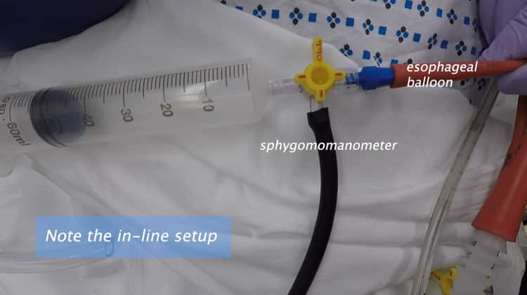 Sengstaken Blakemore Tube