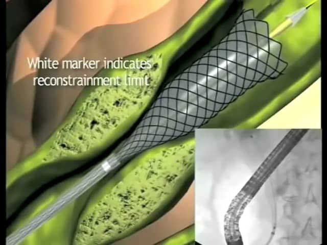 WallFlex® Biliary Metal Stent animation with clinical footage on Vimeo