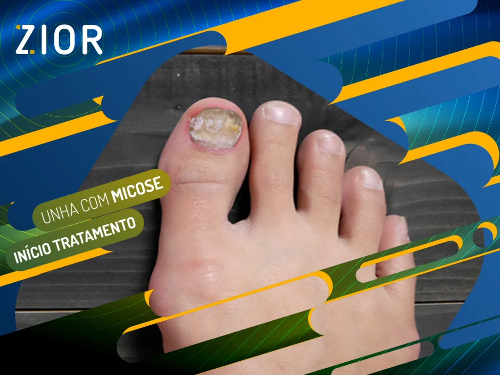 Evolução do tratamento com Zior