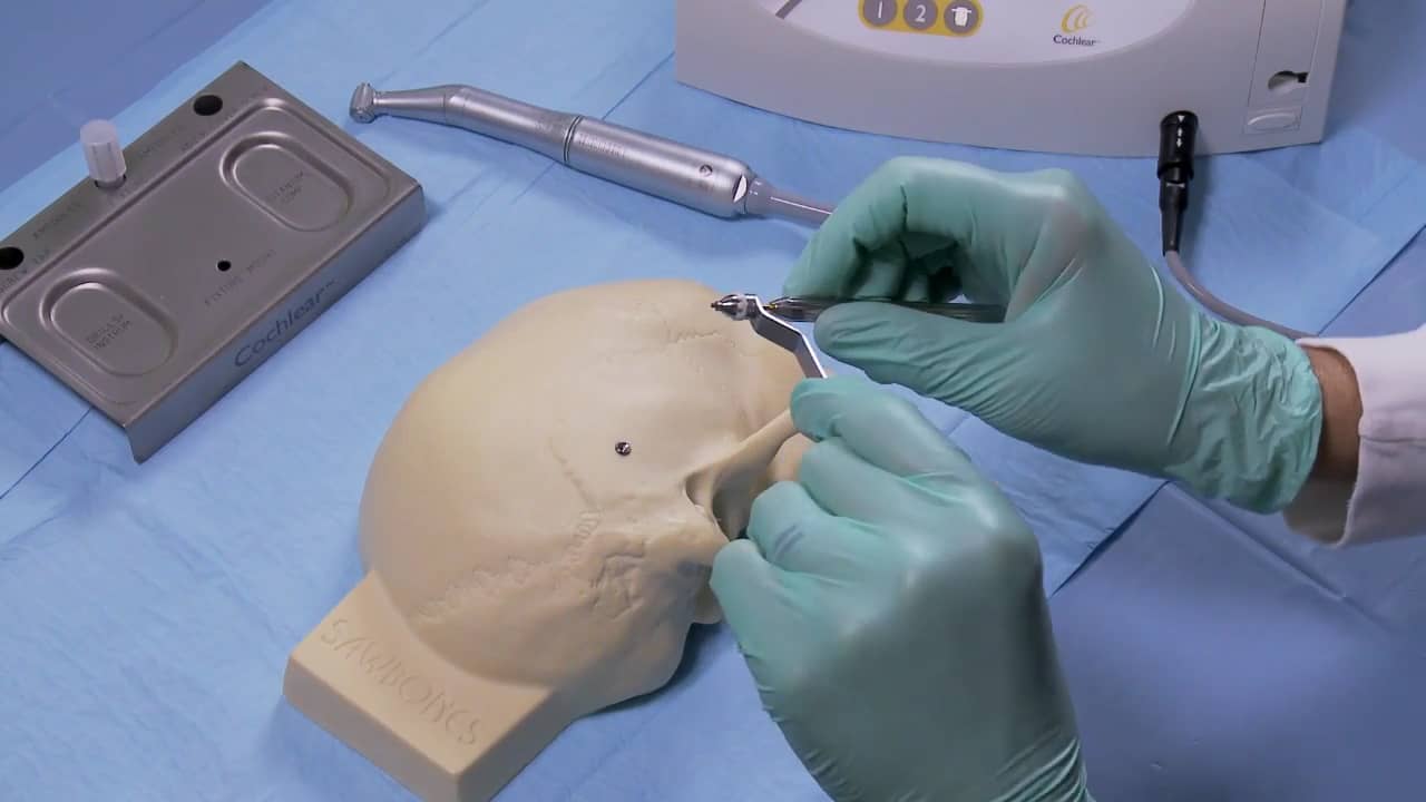 BUN224- Abutment Video 2- BA300 w Osscora on Vimeo