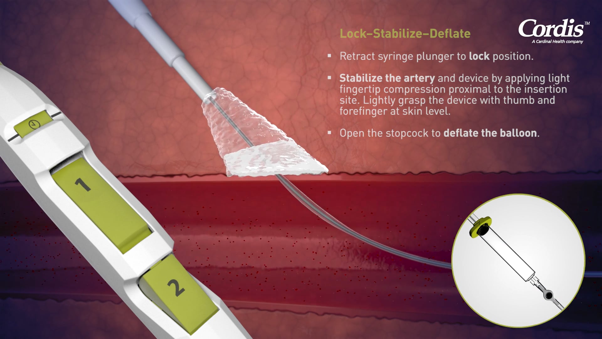 Mynx Control Procedure Animation.mp4 on Vimeo