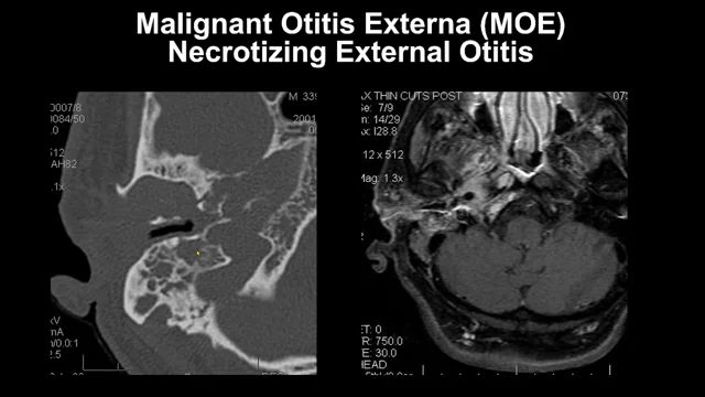 Malignant Otitis Externa Radiology