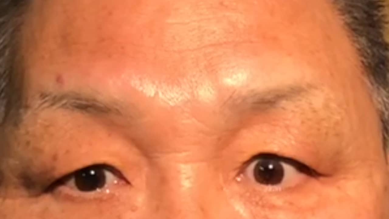 Ocular neuromyotonia caused by a recurrent sphenoidal ridge meningioma ...