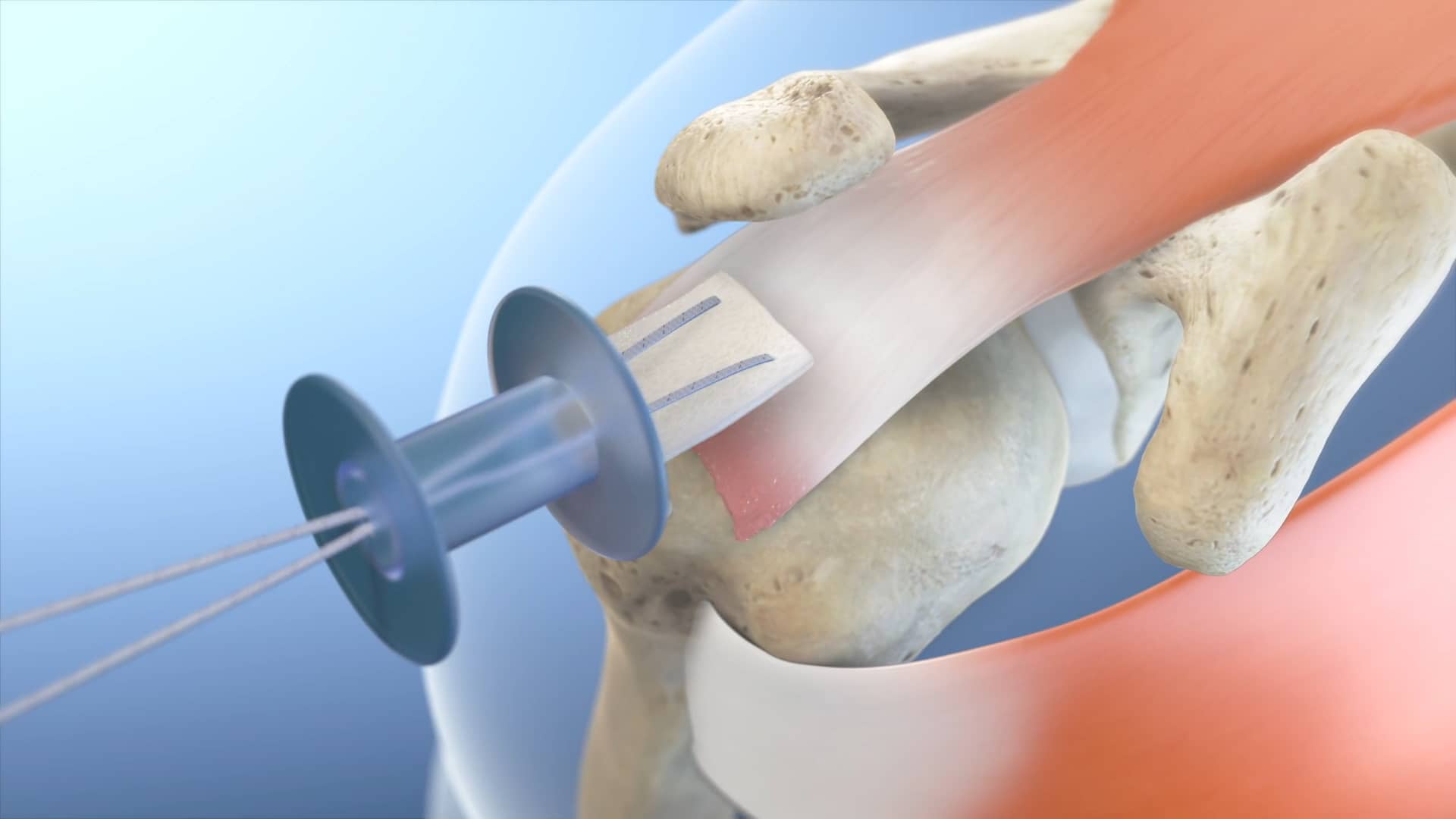 Biorez Rotator Cuff Repair on Vimeo