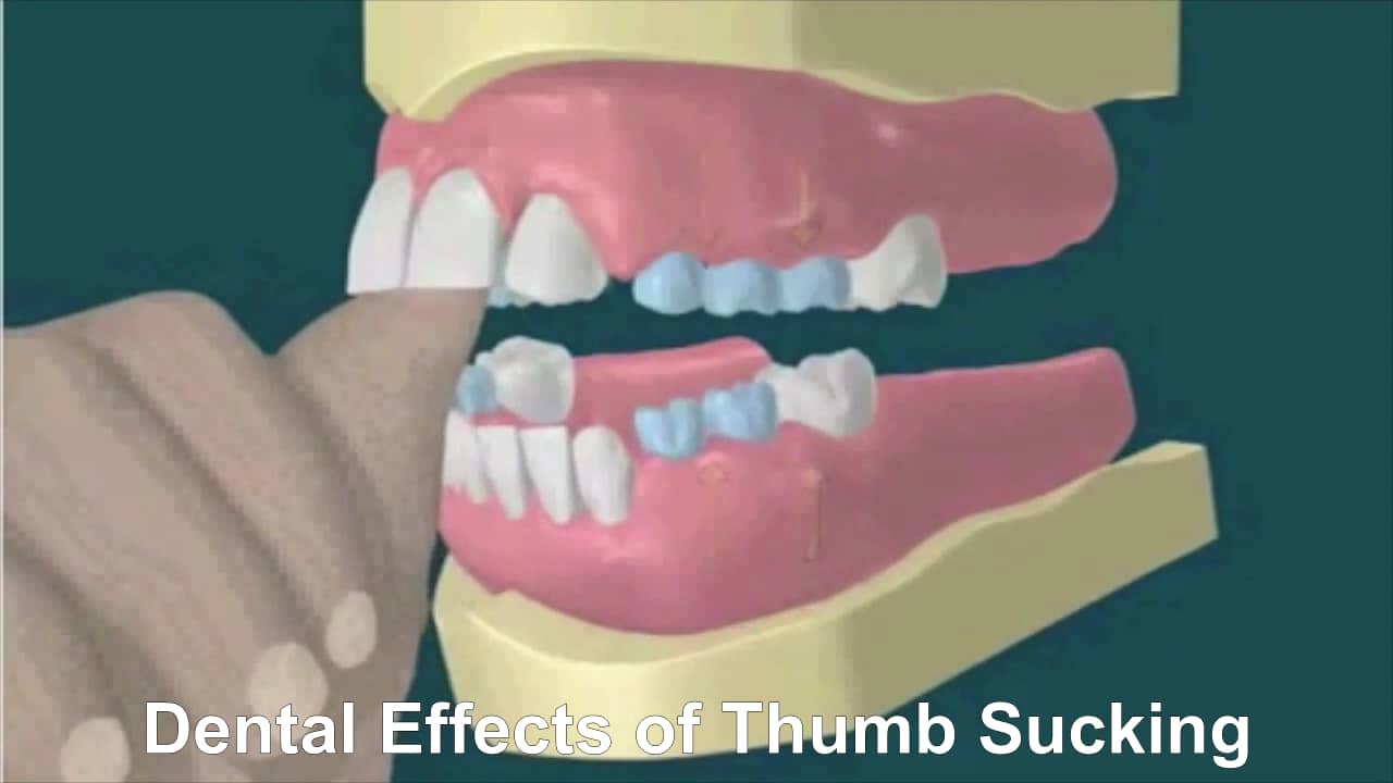 Dental Effects of Thumb Sucking.mp4 on Vimeo