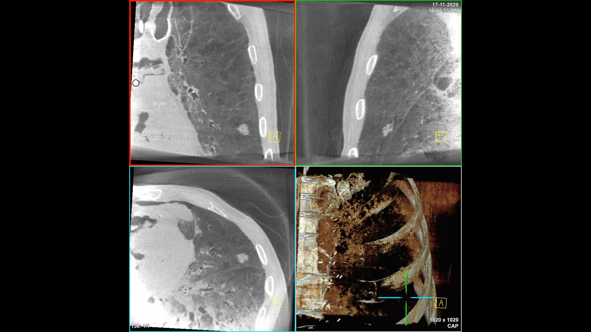 Cios Spin CBCT for Lung Interventions on Vimeo