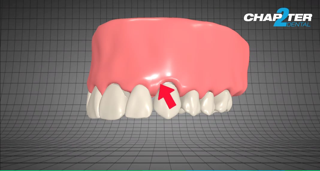 82en-Extractions - Immediate implants (6) - Fixed Custom Bridge (FP1-no ...