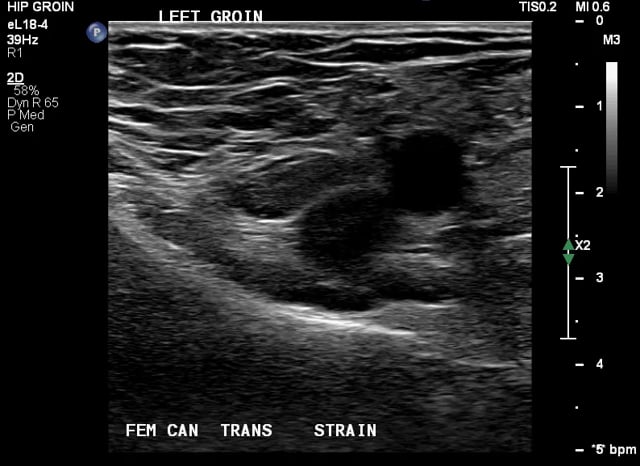 Hernia pathology – ULTRASOUNDPAEDIA