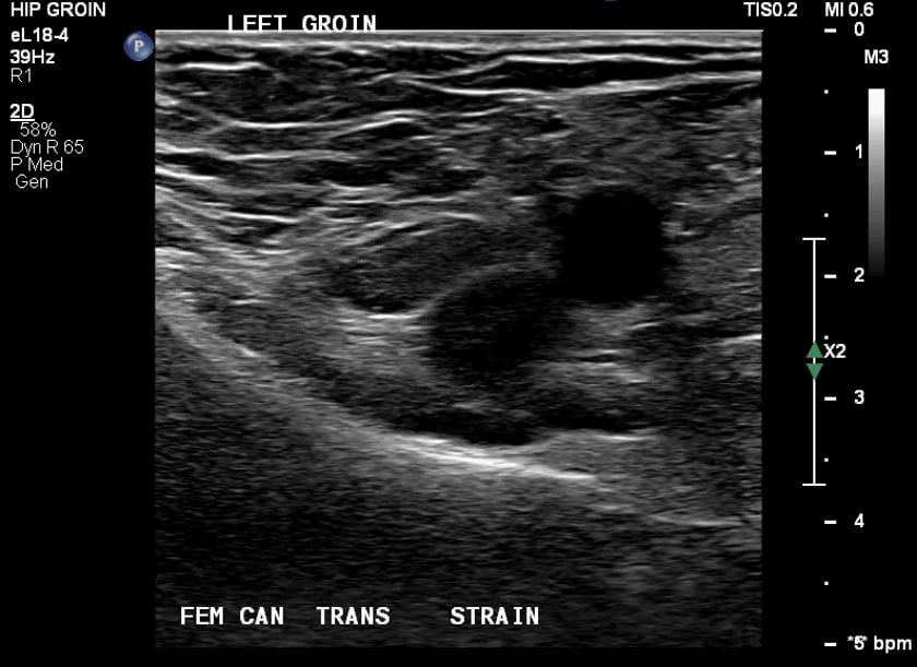 Groin Lymph Nodes Ultrasound