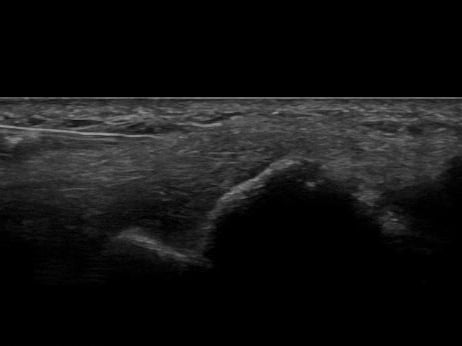 Ultrasound guided common extensor tendon injection on Vimeo