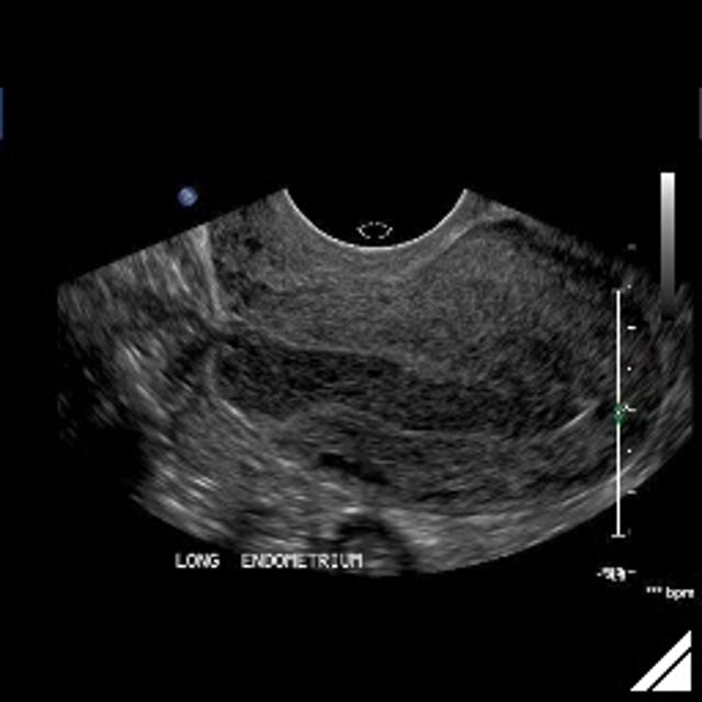 Uterus pathology – ULTRASOUNDPAEDIA