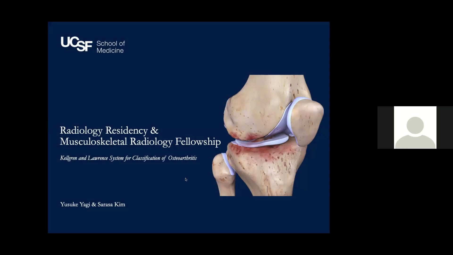 G29. Kellgren and Lawrence System for Classification of Osteoarthritis ...