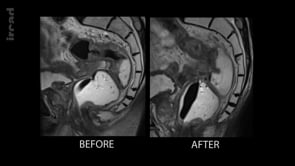 Low anterior resection (LAR) for T3 rectal cancer with the da Vinci Xi ...
