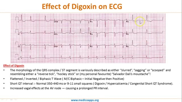 Understanding the Effects on Digoxin on ECG on Vimeo