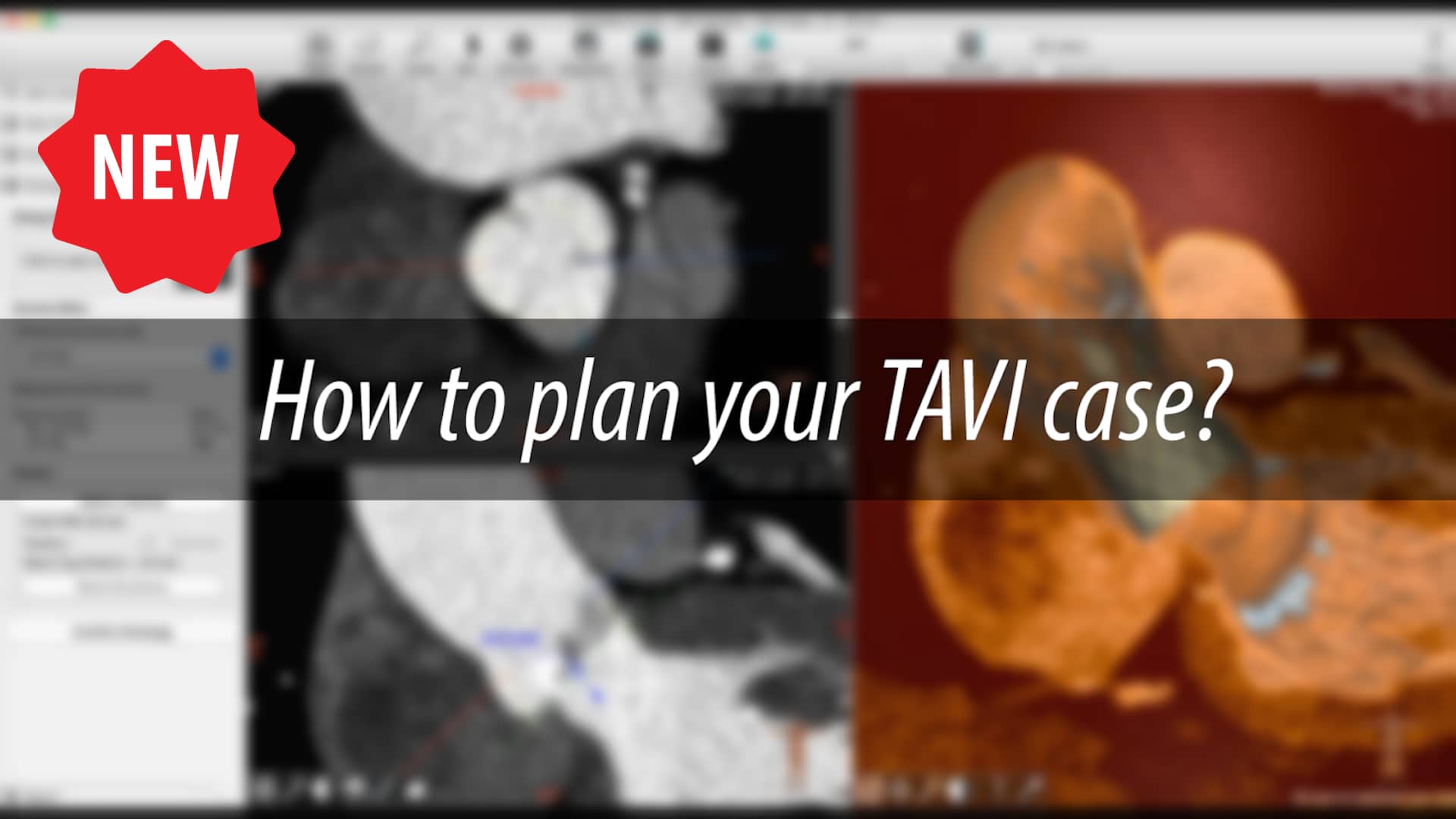 How to plan your TAVI case? on Vimeo