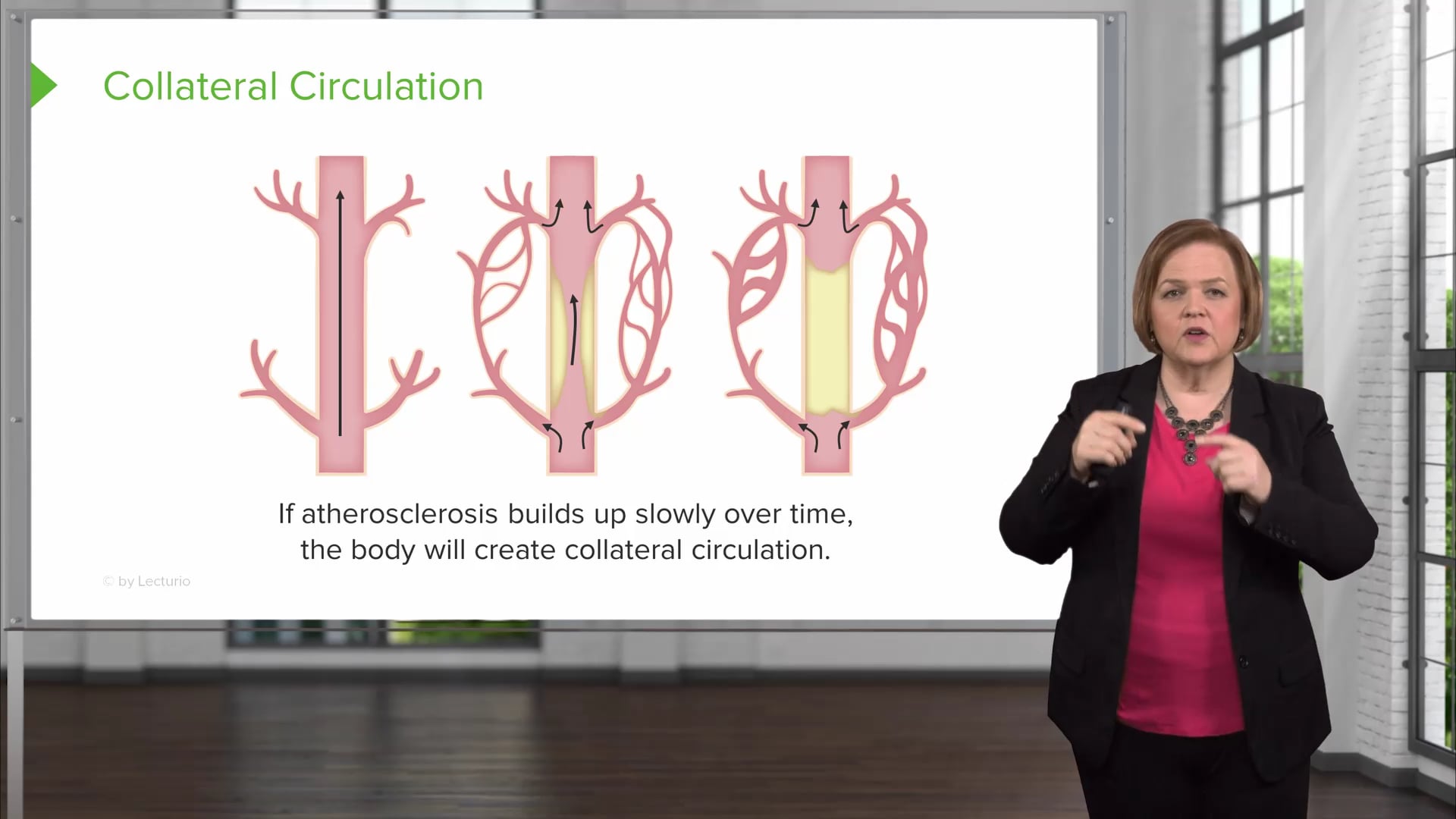 Med-surg Nursing(Cardiovascular Disorders-Atherosclerosis Collateral ...