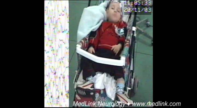 Eyelid myoclonia with and without absences | MedLink Neurology