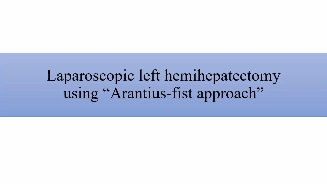 LAPAROSCOPIC LEFT HEMIHEPATECTOMY USING ARANTIUS-FIRST APPROACH.mp4 on ...