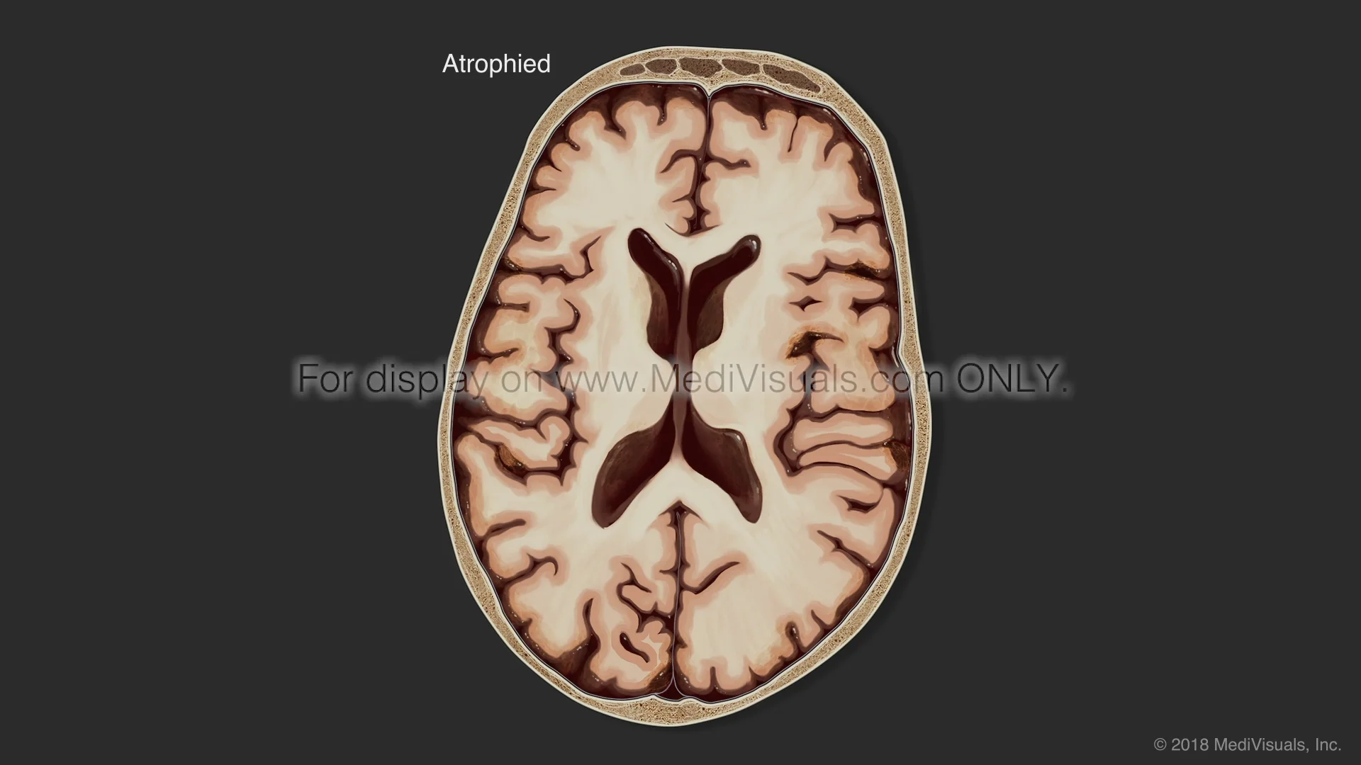 Atrophy Animation-MVI1802 on Vimeo