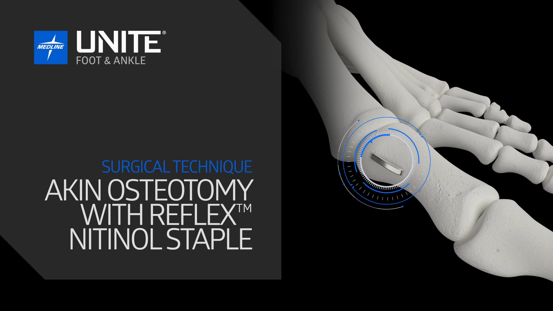 Akin Osteotomy with REFLEX Nitinol Staple System on Vimeo