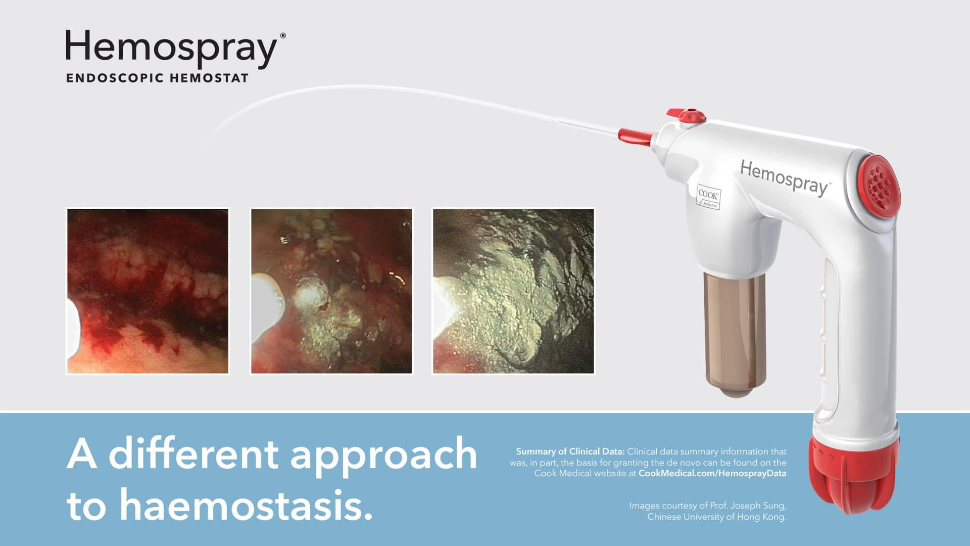 Hemospray Endoscopic Hemostat on Vimeo