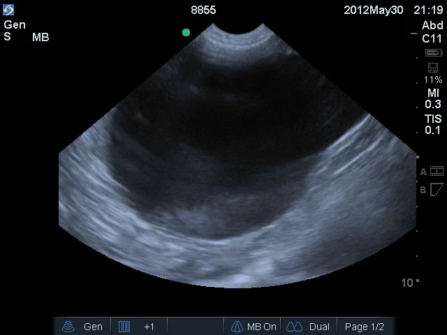 Normal Bladder Ultrasound