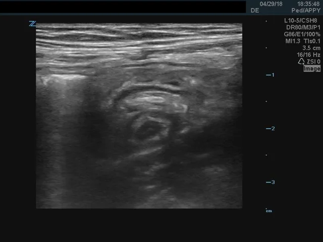Graded Compression Ultrasound