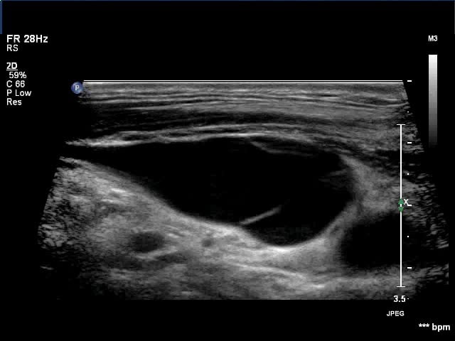 Venous Incompetence – ULTRASOUNDPAEDIA