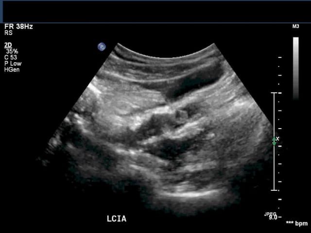 Leg Arterial pathology – ULTRASOUNDPAEDIA