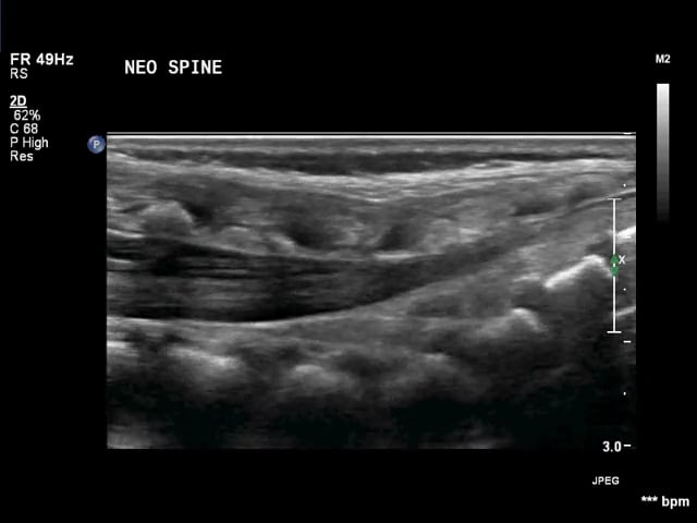 Neonatal Spine Normal – ULTRASOUNDPAEDIA