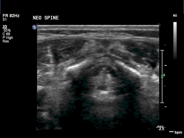 Neonatal Spine Normal – ULTRASOUNDPAEDIA