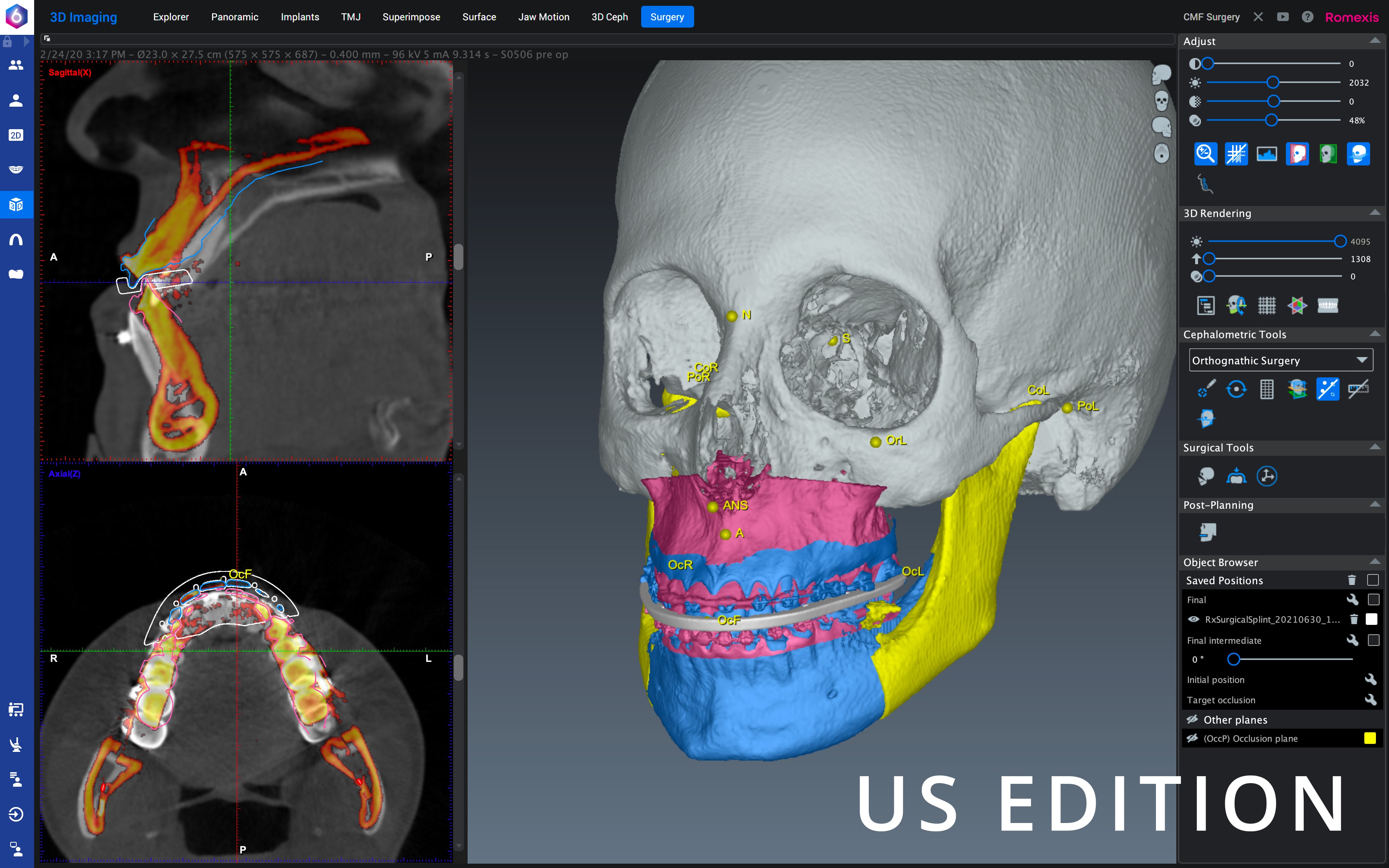 How to - Use Romexis CMF Surgery v.6.2 USA on Vimeo