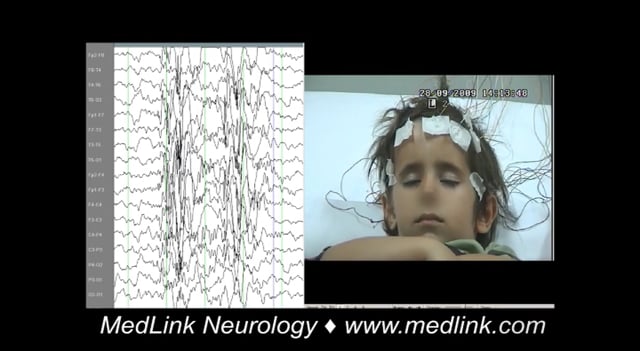 Typical absences | MedLink Neurology