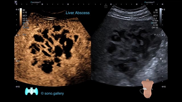 Splenic Haemangioma - SONO.GALLERY