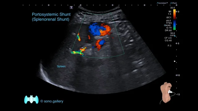 Splenorenal Shunt