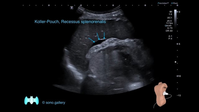 Koller-Pouch, Recessus splenorenalis - SONO.GALLERY