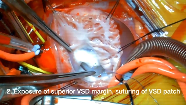 Two-patch transannular repair of tetralogy of Fallot with complete ...