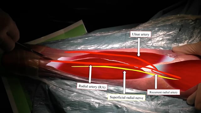 Conventional open harvesting of the radial artery as a conduit for ...