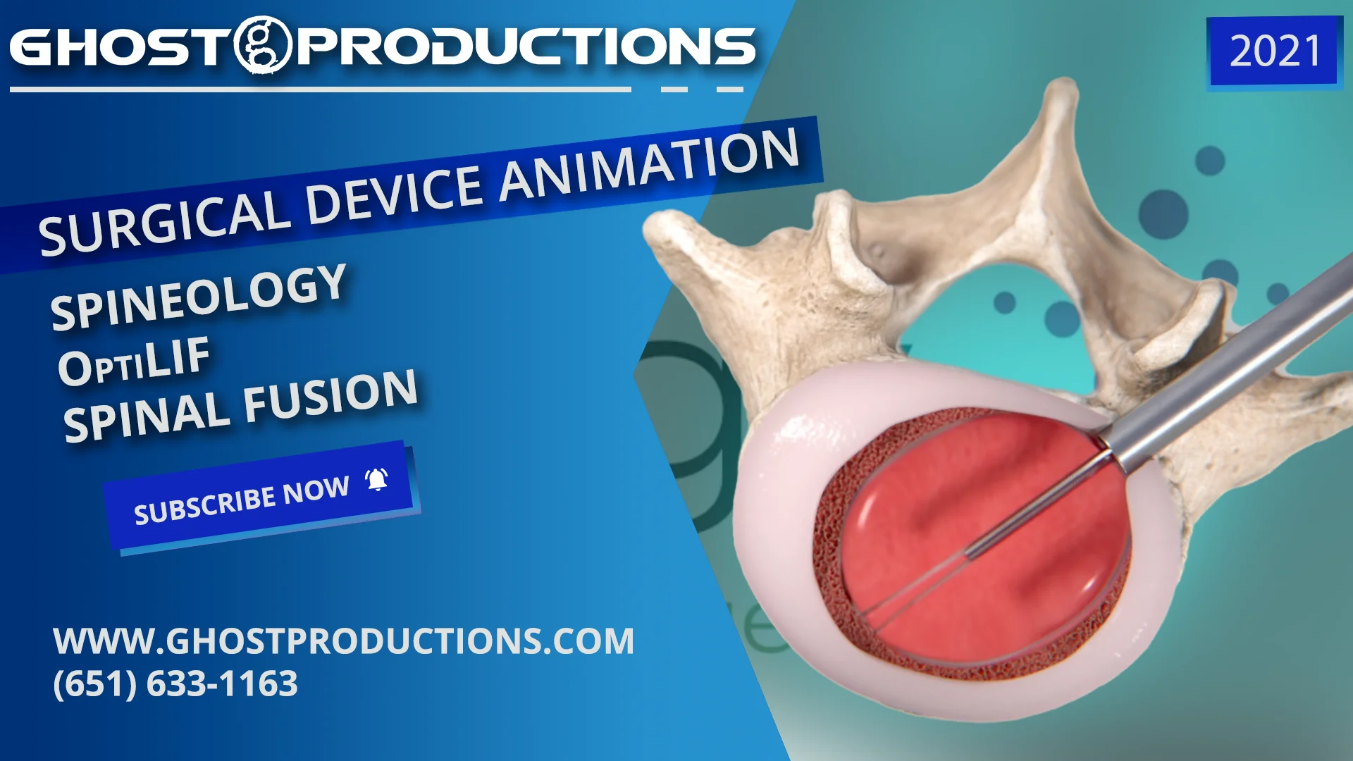 Medical Animation: Spineology OptiLIF Spinal Fusion - Ghost Productions ...