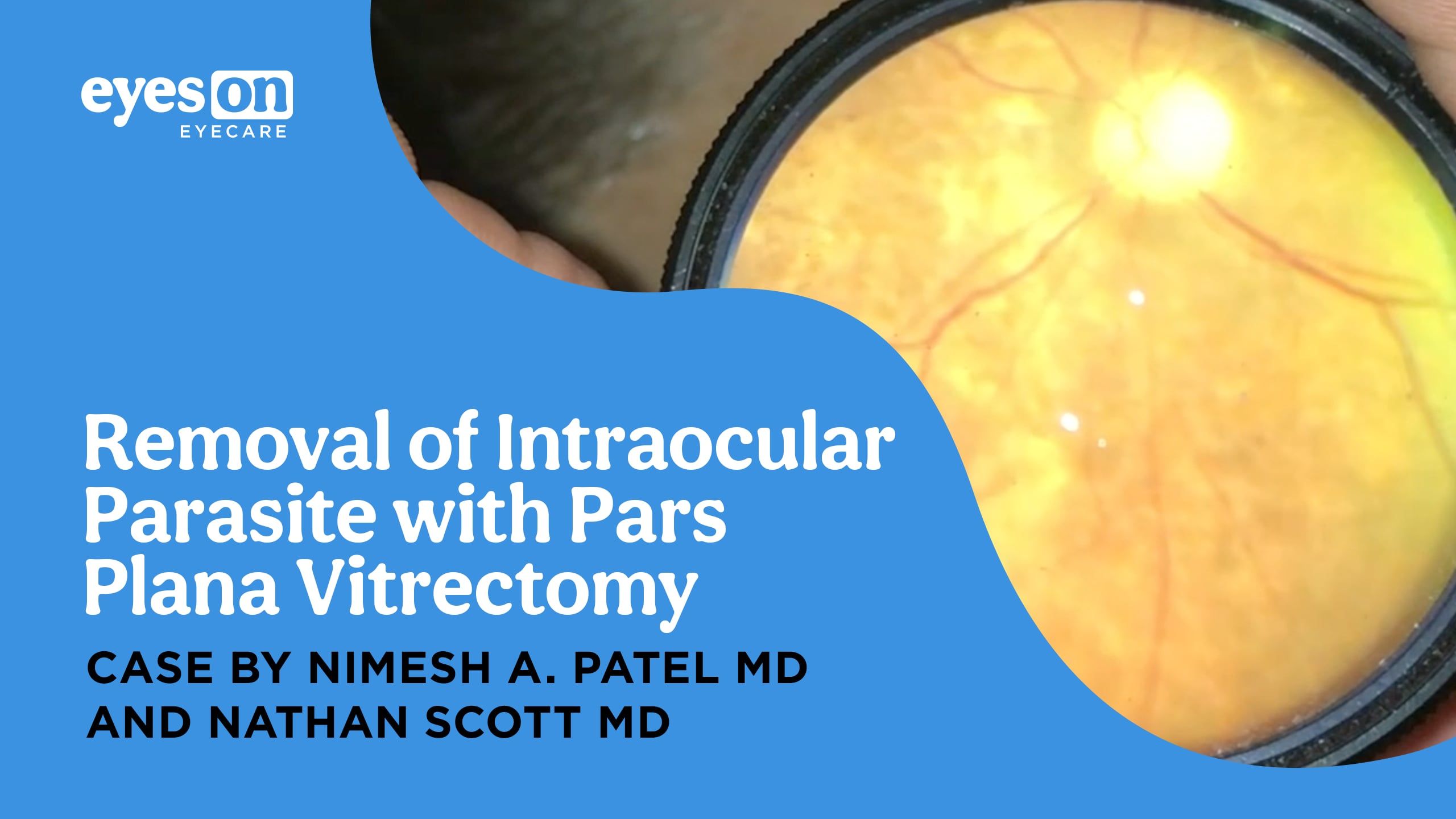 Removal of Intraocular Parasite with Pars Plana Vitrectomy on Vimeo