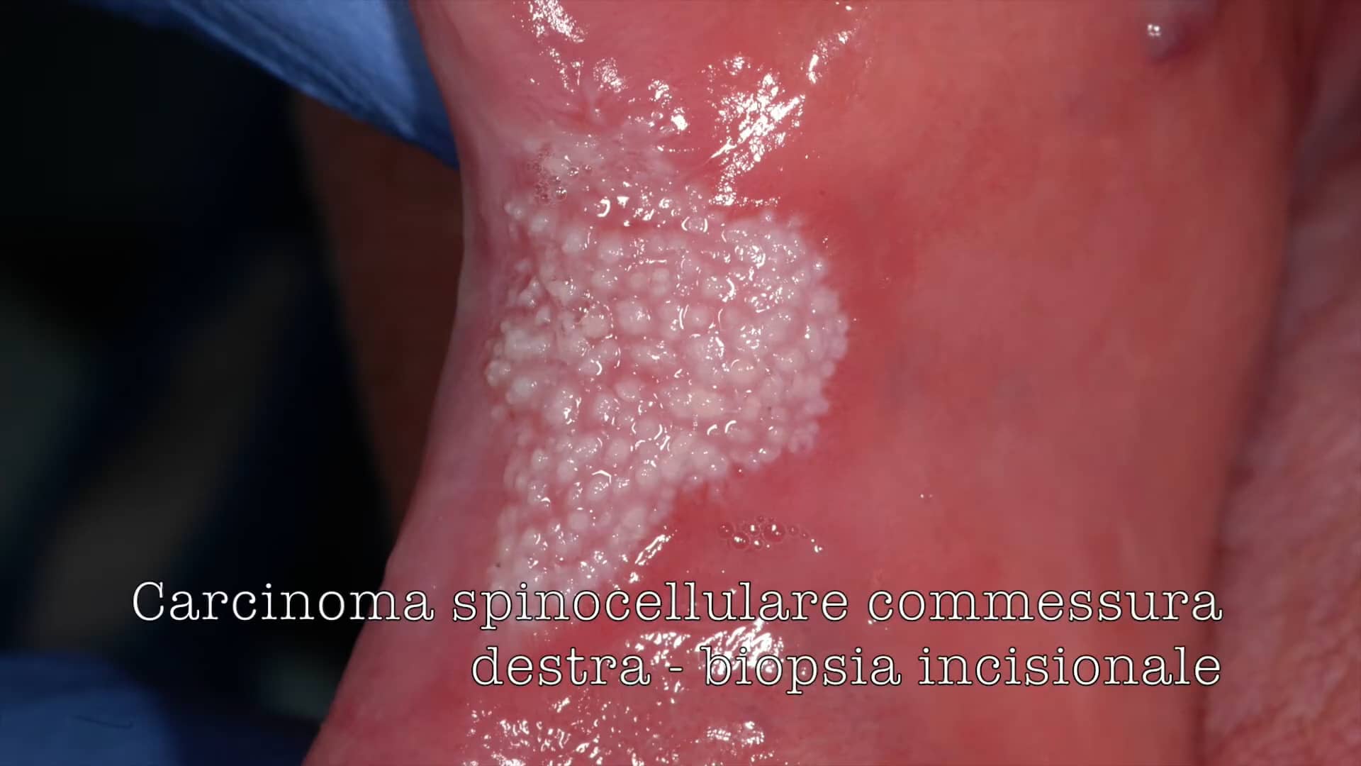 Dott. Mariani Umberto - CARCINOMA SPINOCELLULARE BIOPSIA.mp4 on Vimeo