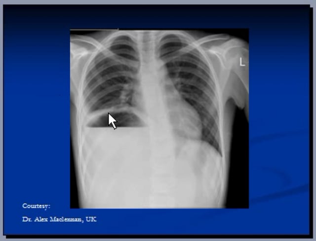 Chest x-ray interpretation, Subphrenic abscess on Vimeo